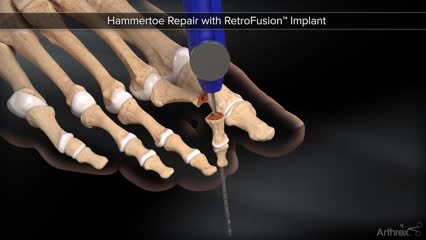 rapidsave.com_how_hammerhead_toes_are_repaired-pr8acsssmaqa1