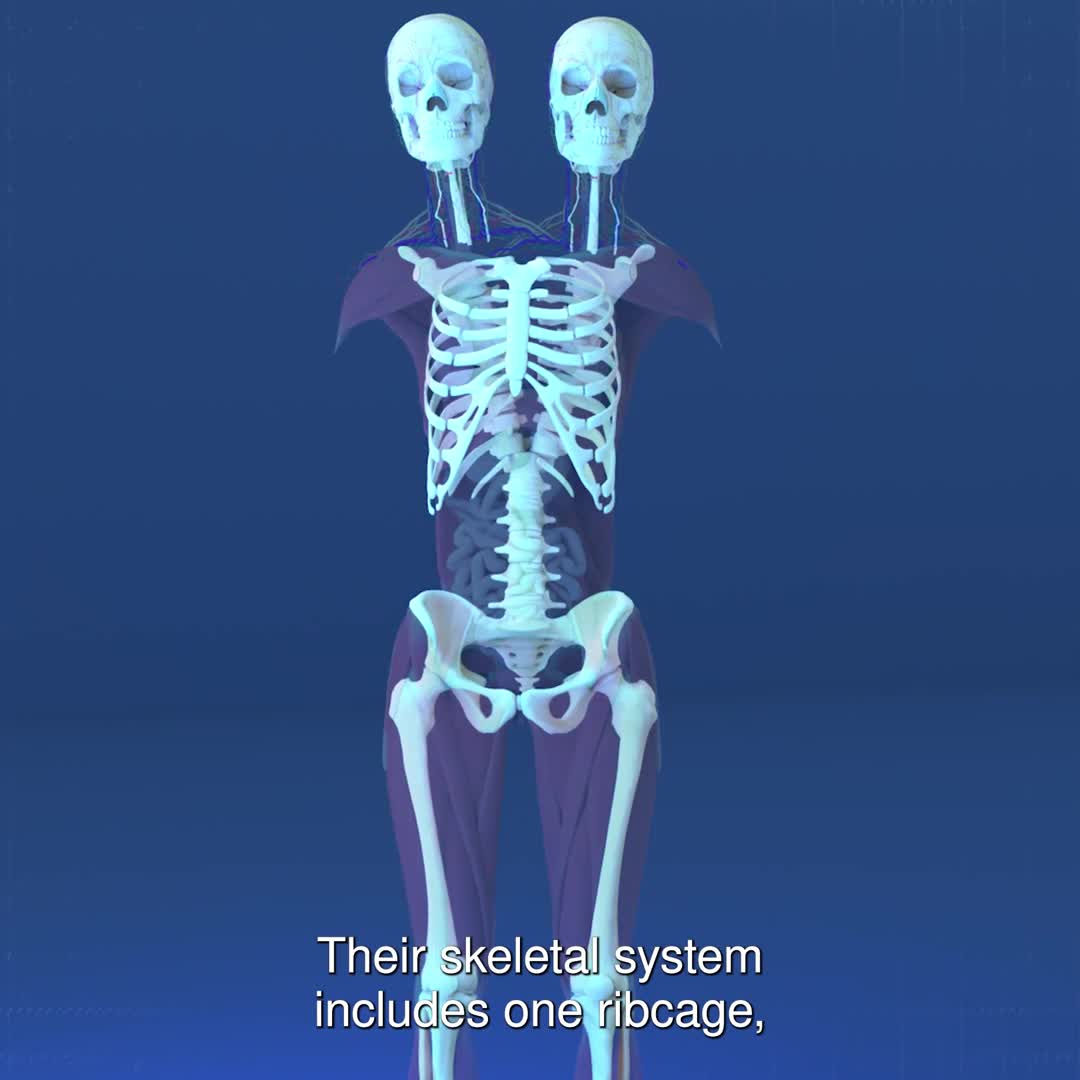 Watch rapidsave.com_two_heads_one_body_anatomy_of_conjoined_twins ...